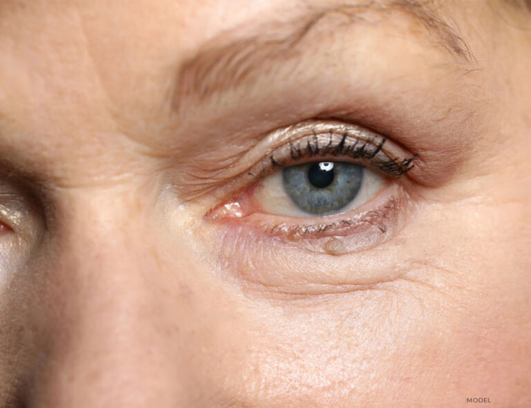 Eyelid Lumps and Bumps Removal | Chicago Oculofacial