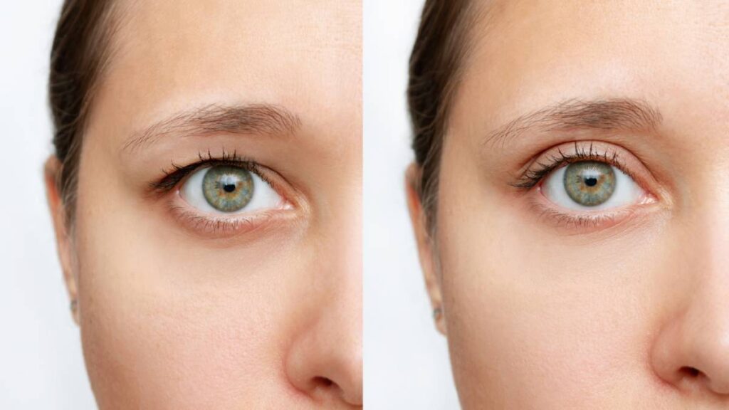 What Are the Dos and Don'ts After Upper Eyelid Surgery? | Chicago ...